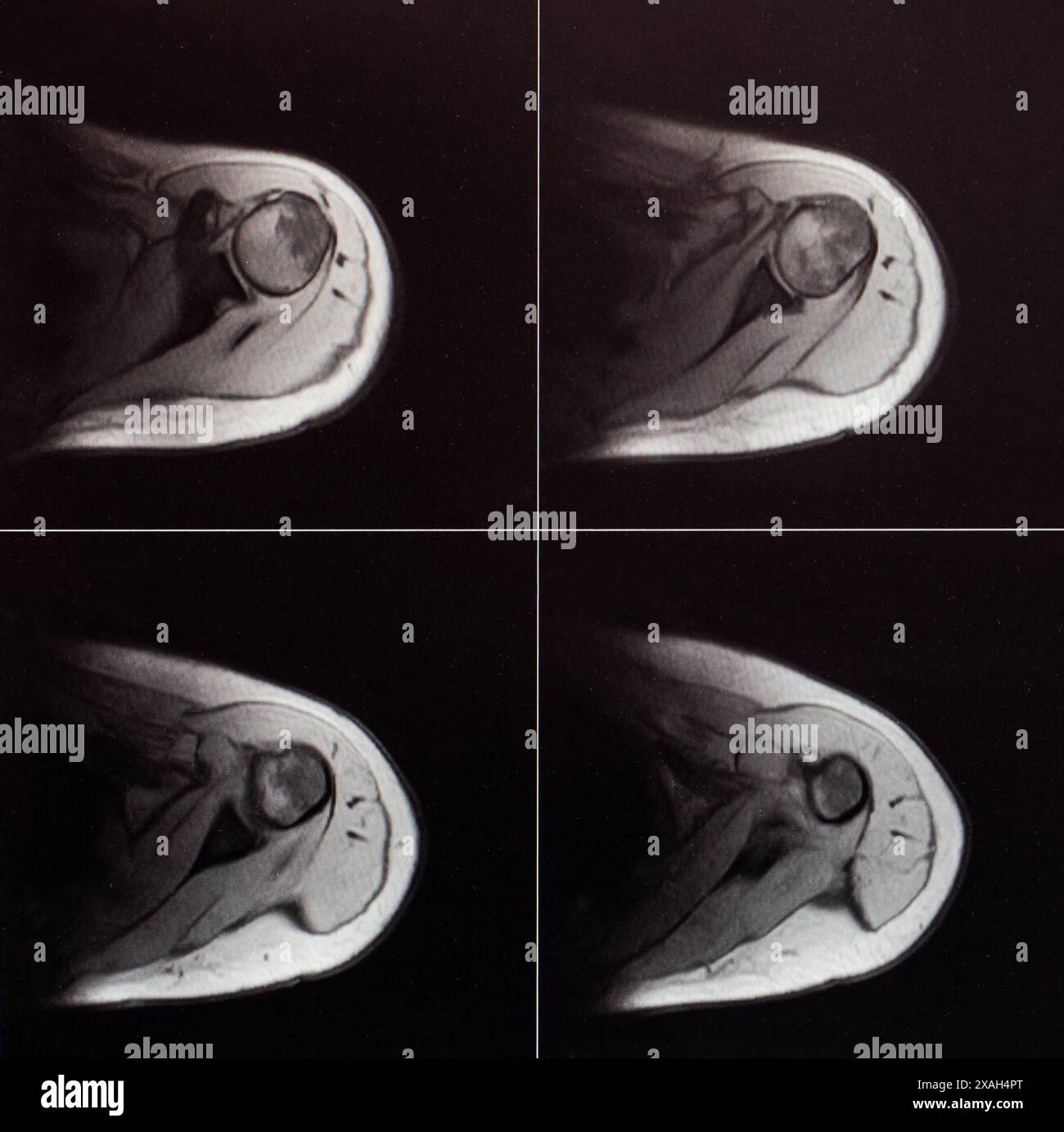 MRI image of the shoulder joint after dislocation. Impression fracture of the humeral head ...