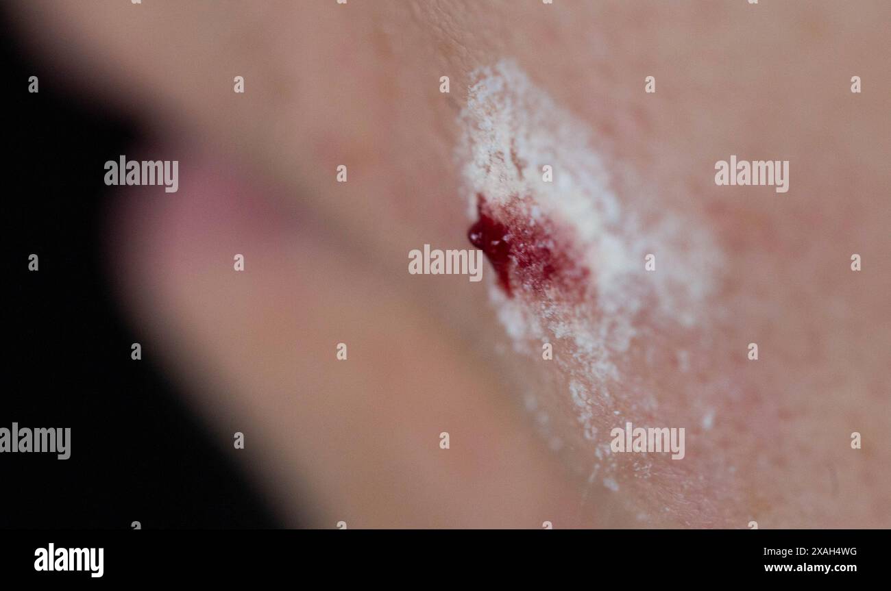 Blood and a wound on a girl s cheek after an injury. Ointments and ...