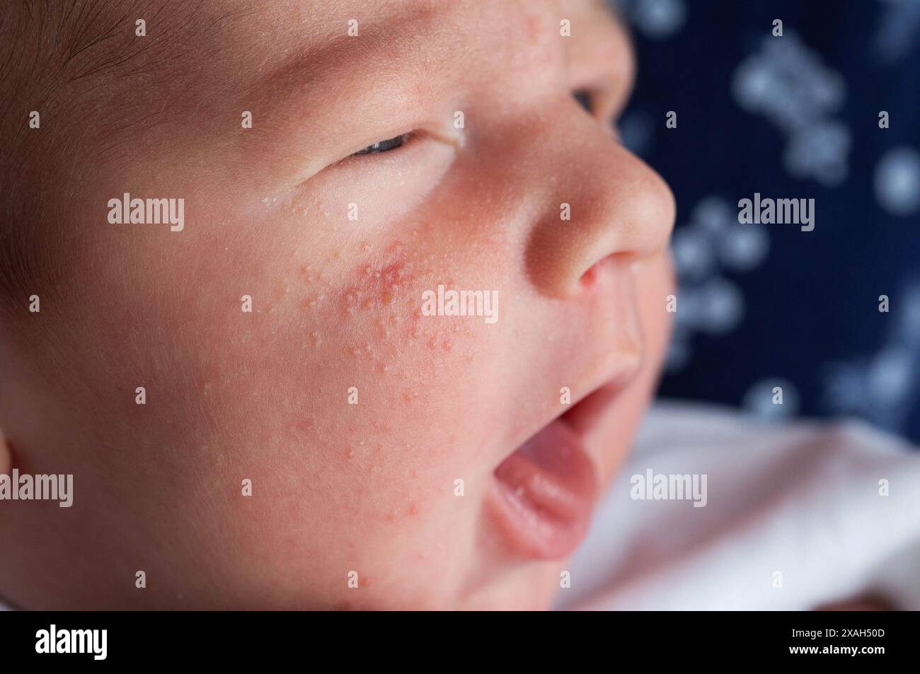 Acne in newborns hi-res stock photography and images - Alamy