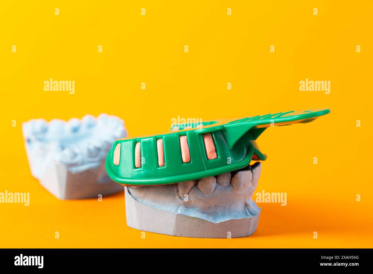 Green dental impression tray on a blue plaster jaw of a patient on a ...