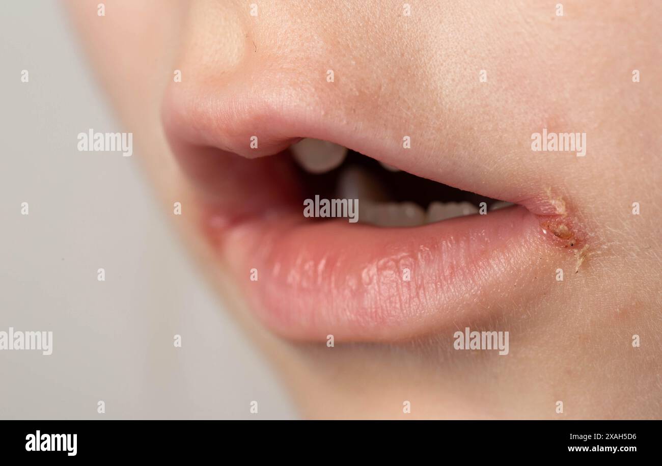 slit-like impetigo in a little girl in the corners of her mouth. Skin ...