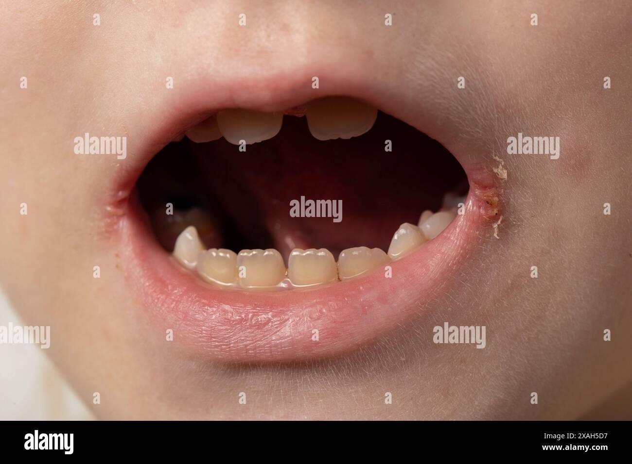 Pain and itching in the corners of the lips of a girl's mouth. Seizures ...