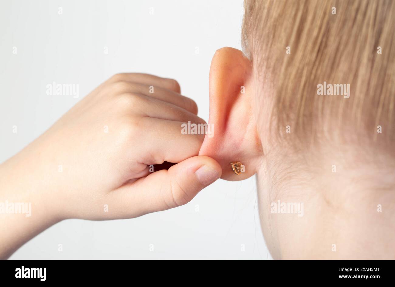 Pediatric otoplasty hi-res stock photography and images - Alamy