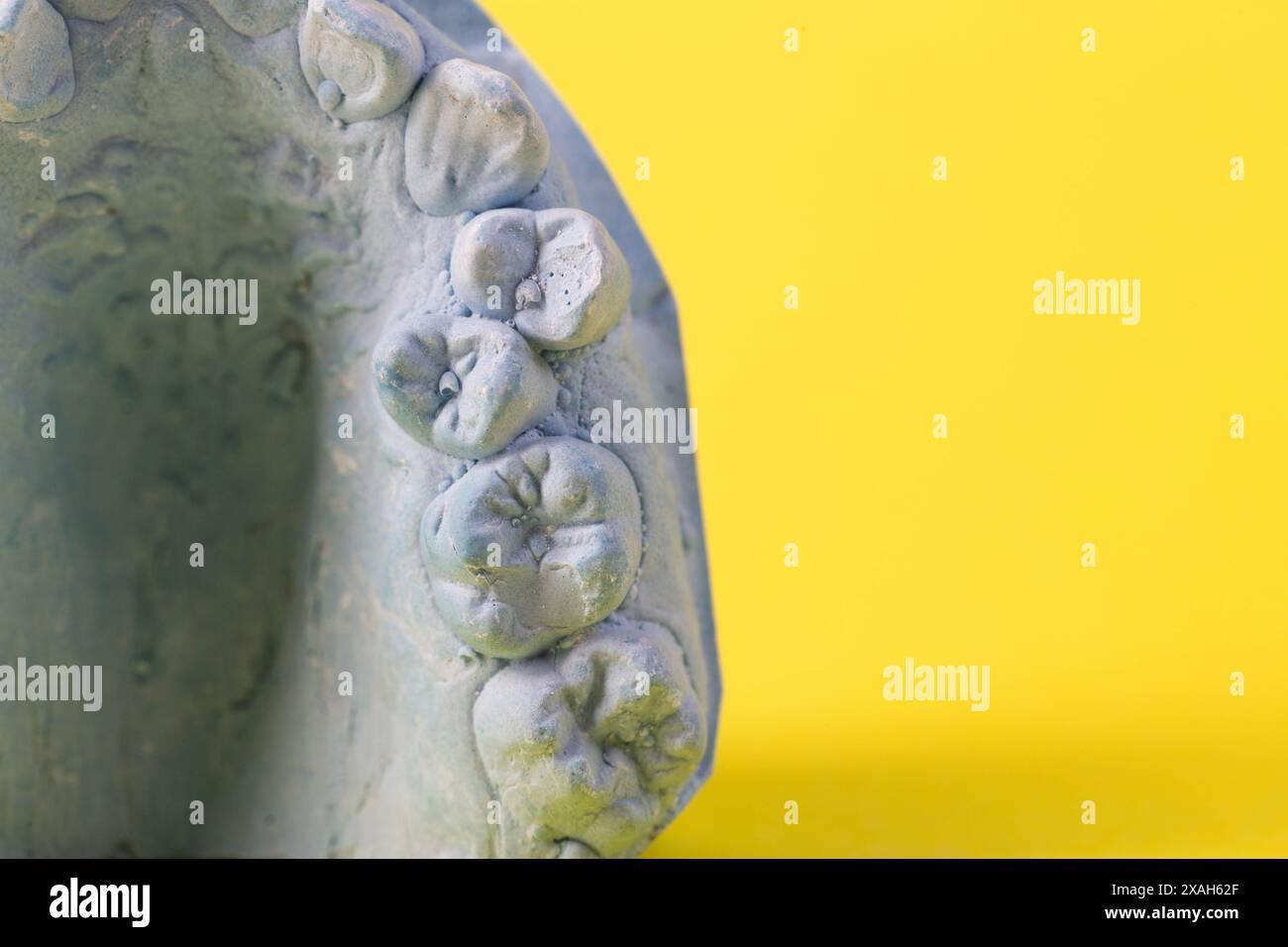 Blue plaster impression of a patient's dental jaw with crooked teeth ...