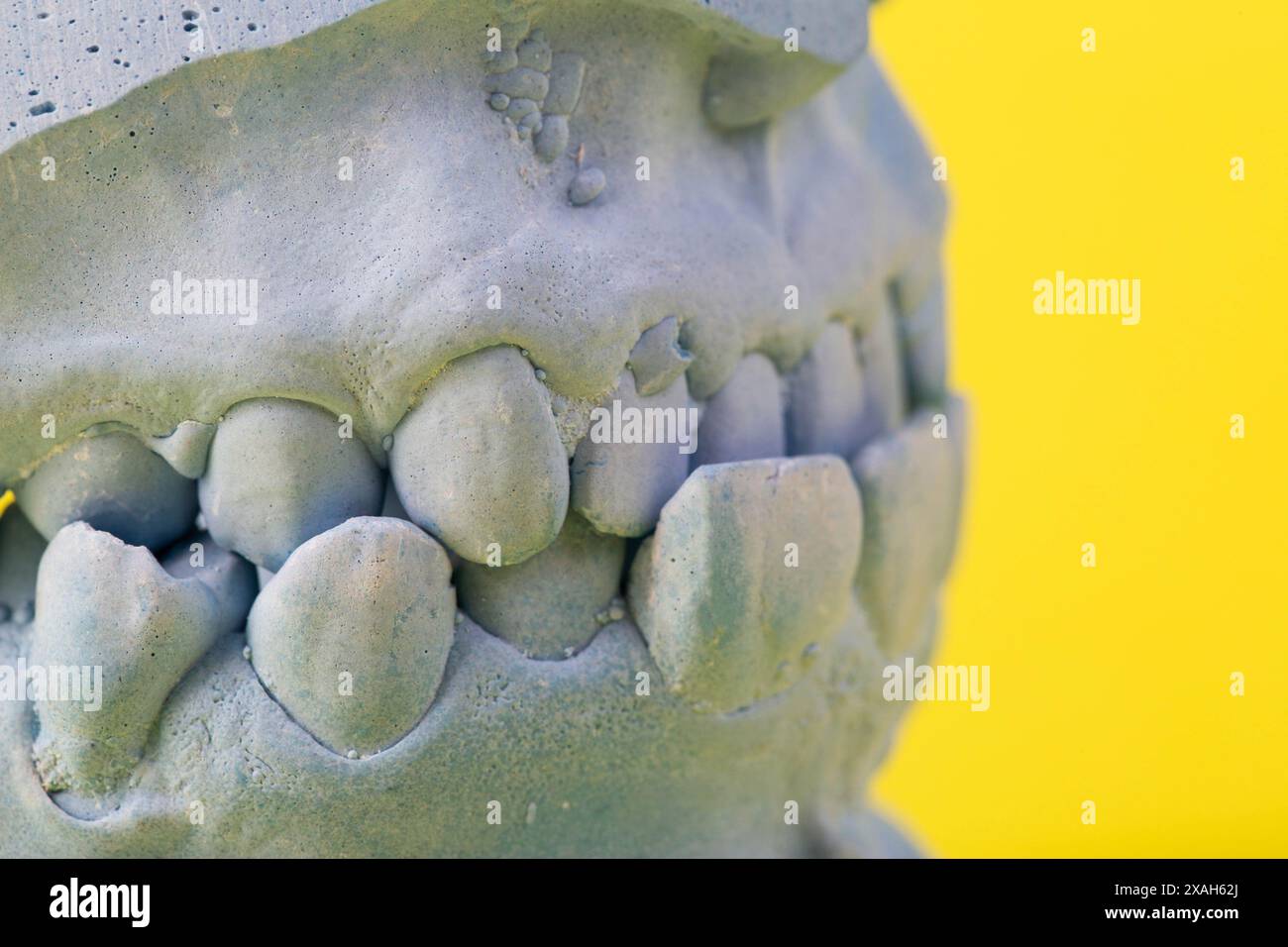 Blue plaster impression of the dental jaw of a patient with crooked ...
