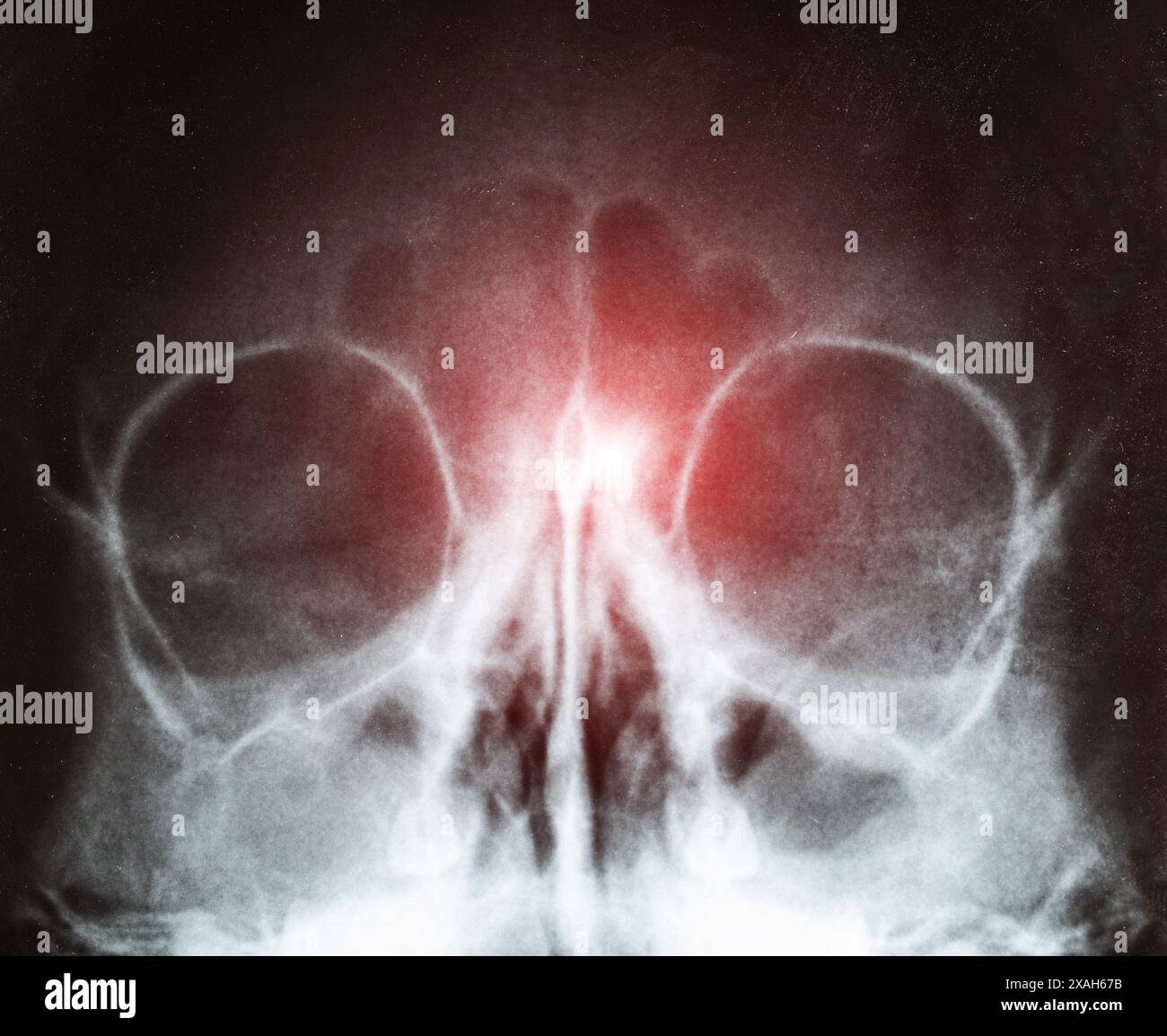 X-ray of sinusitis in a child. Inflammation of the nasal sinuses with ...