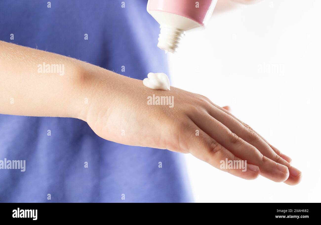 A girl applies medicinal cream to her hands for dermatitis and skin ...