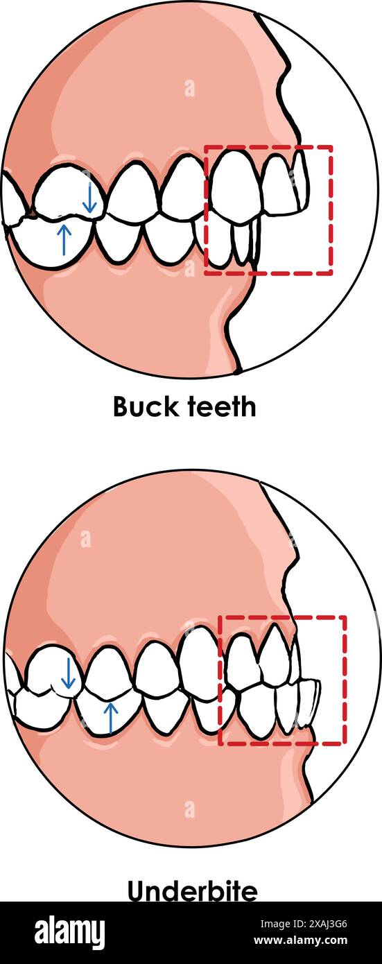 Bucco-version tooth an outward positioning of the teeth projecting ...