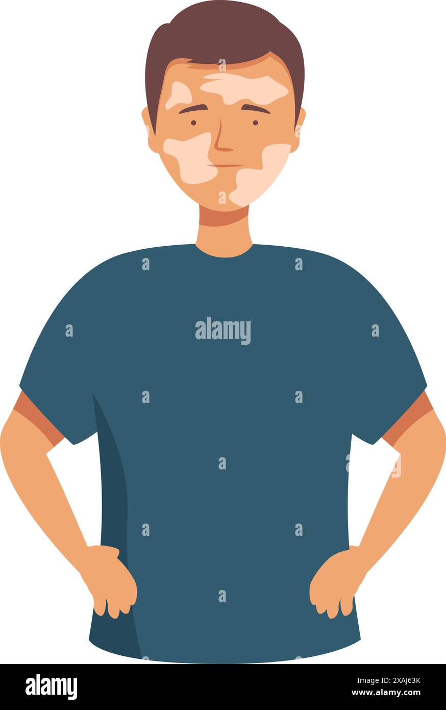 Young man with vitiligo skin condition is posing confidently hi-res ...