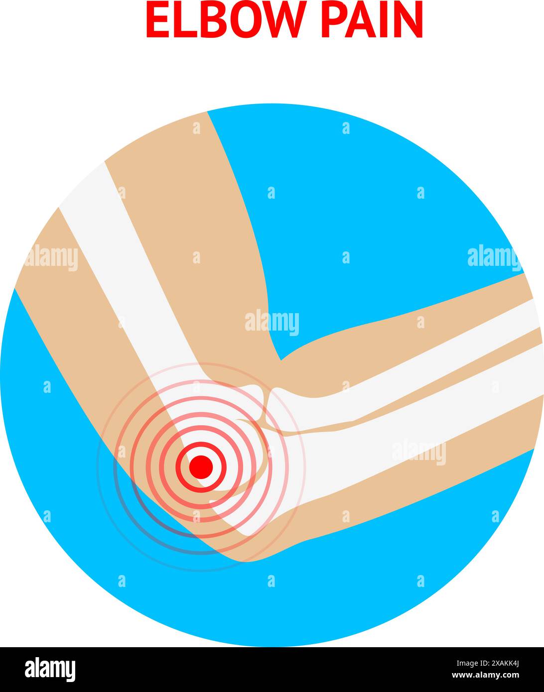 Elbow joint inflammation vector vectors hi-res stock photography and ...