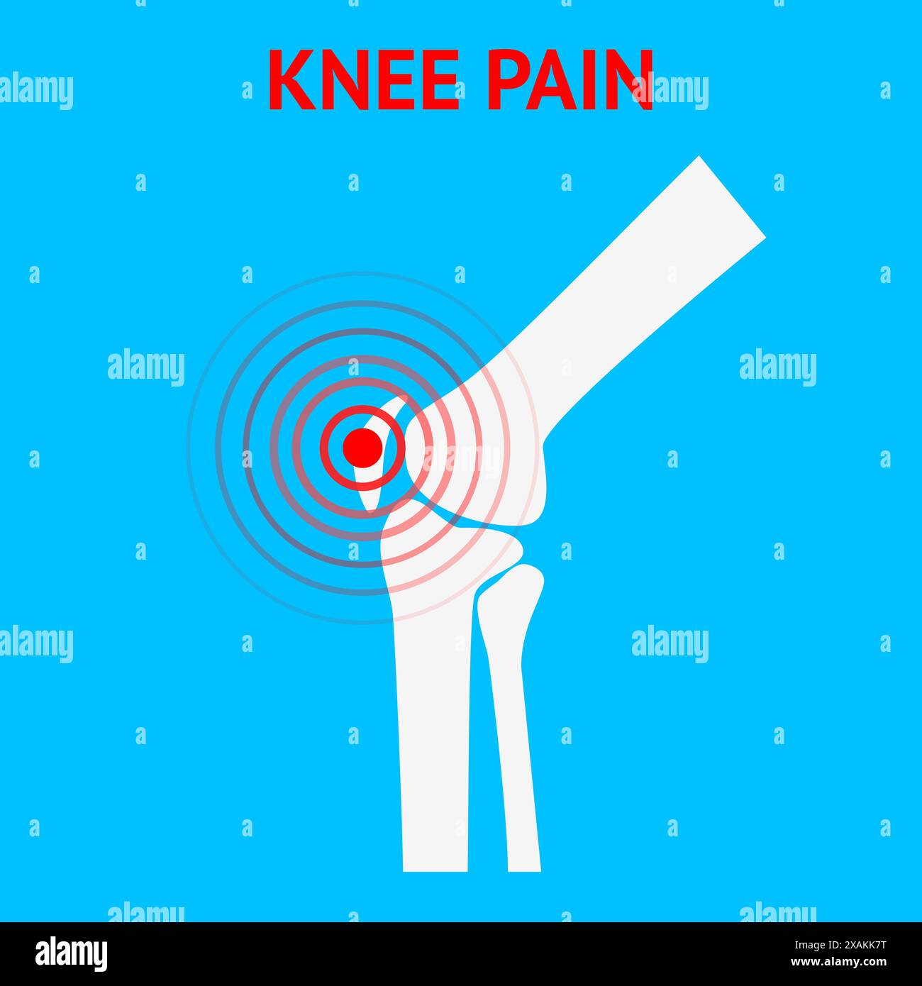 Knee ligament strain Stock Vector Images - Alamy