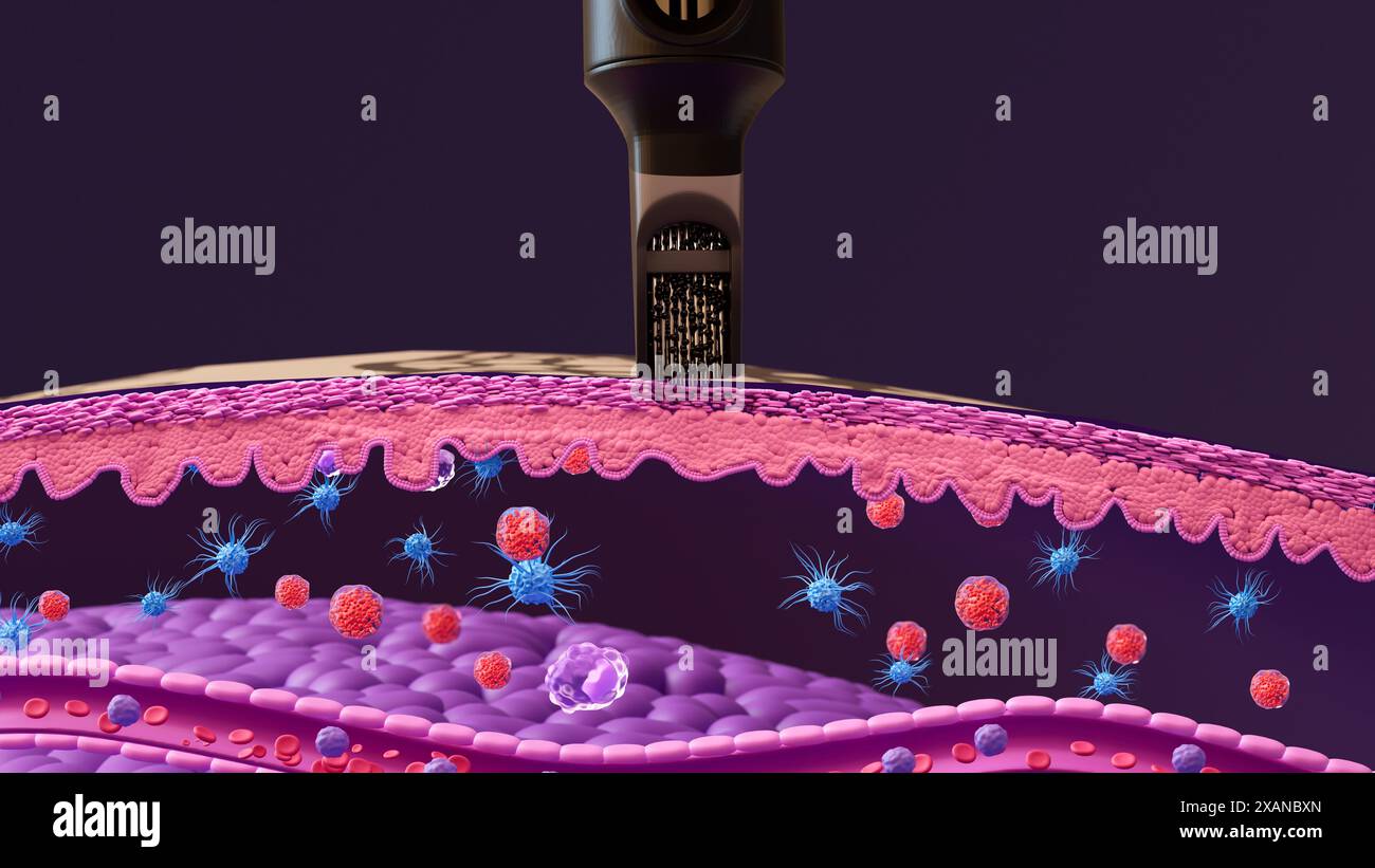 Illustration showing the skin tissue of an arm being tattooed by a ...