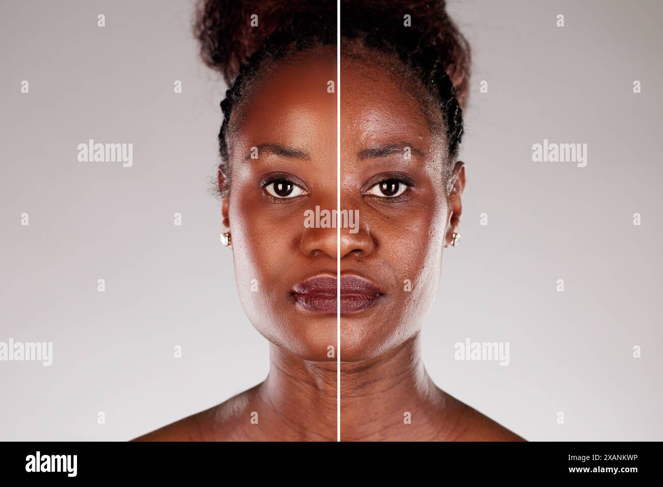 The Transformation of a Young African American Woman's Skin: Before and ...