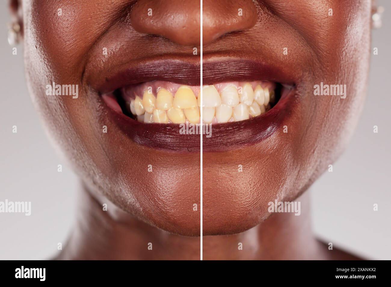 Transformation: From Yellow to Pearly Whites - A Dental Journey Before ...