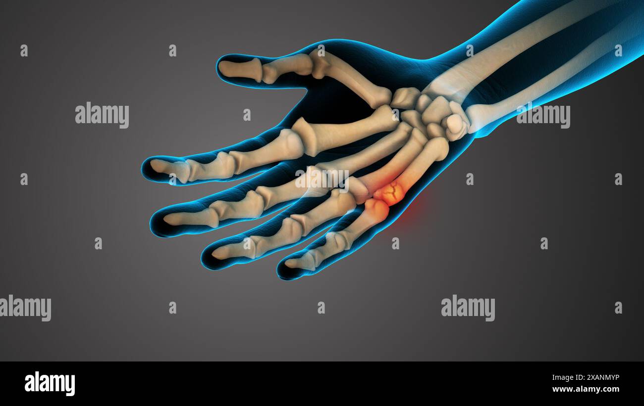 Hand metacarpal Cracked bone Anatomy Stock Photo - Alamy