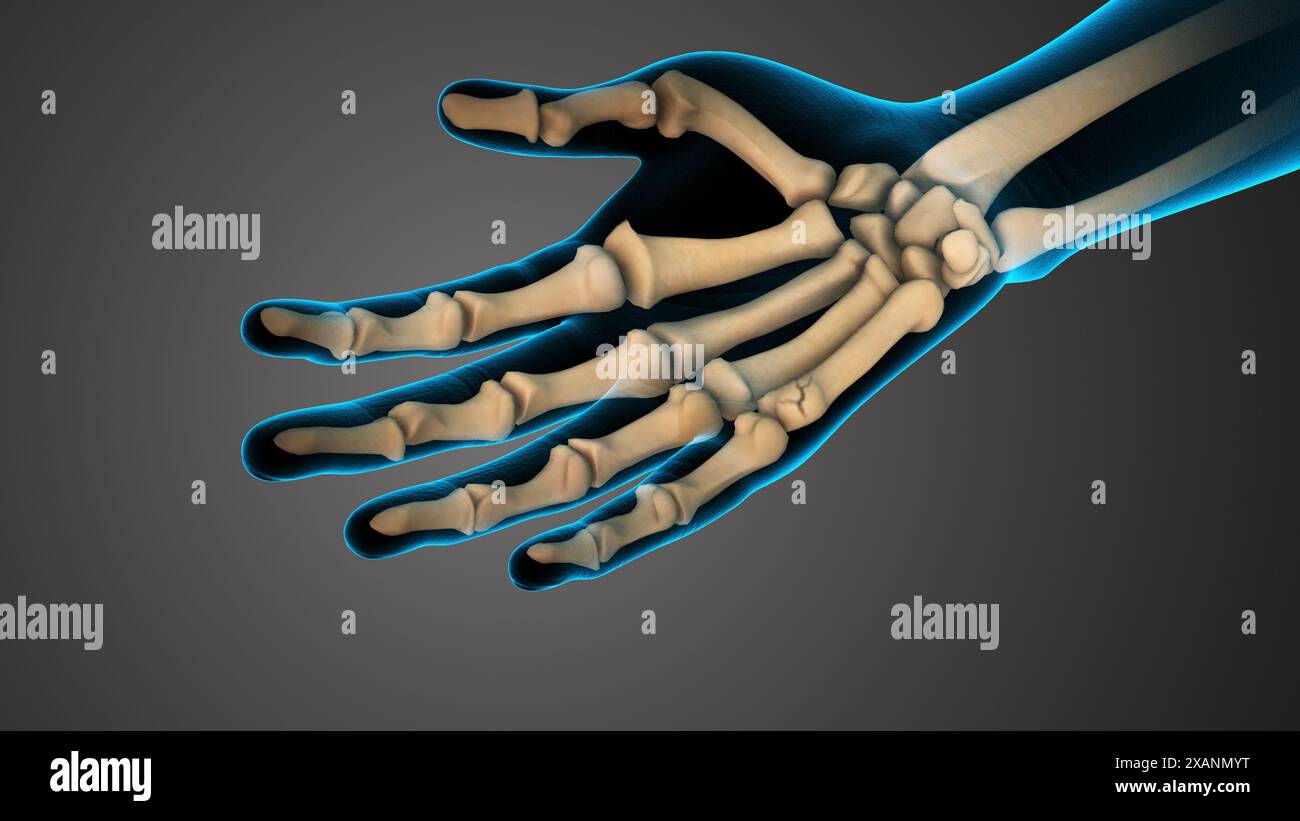 Hand metacarpal Cracked bone Anatomy Stock Photo - Alamy