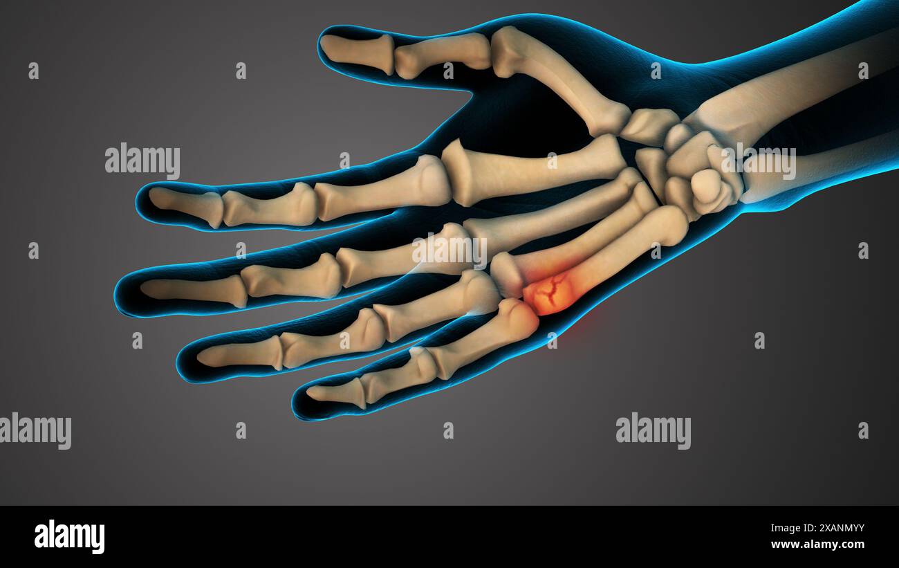 Metacarpal fracture hi-res stock photography and images - Alamy
