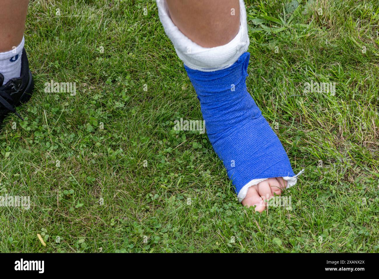 Boy with a broken leg in a cast during a football match an injury to a ...