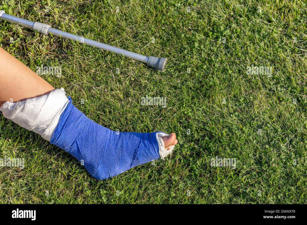 Boy with a broken leg in a cast during a football match an injury to a ...