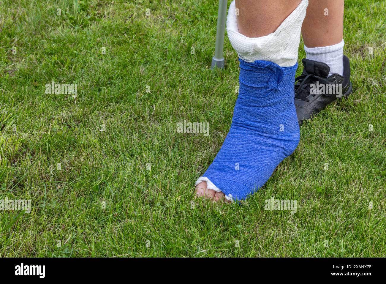 Boy with a broken leg in a cast during a football match an injury to a ...