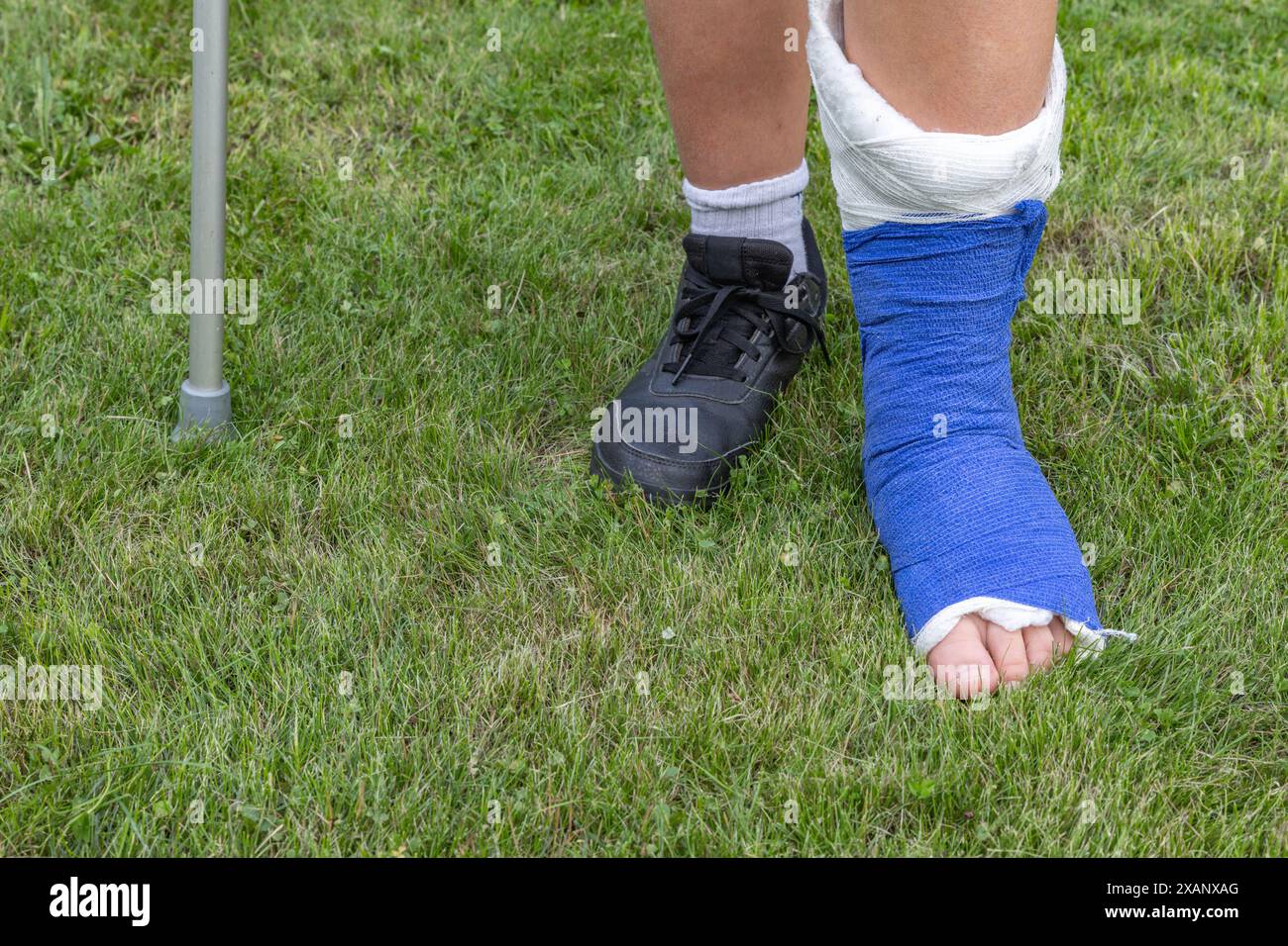 Boy with a broken leg in a cast during a football match an injury to a ...