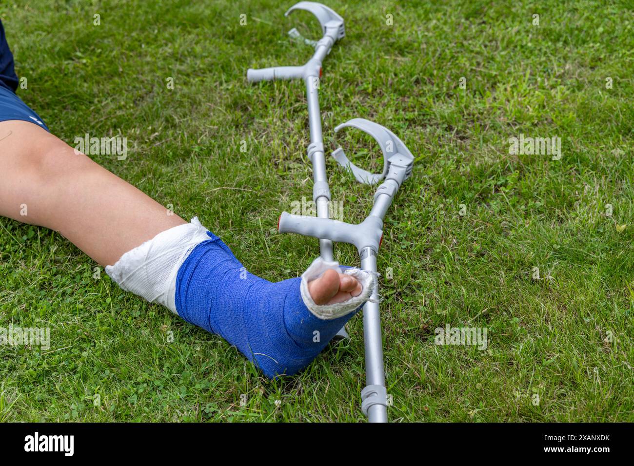 Boy with a broken leg in a cast during a football match an injury to a ...