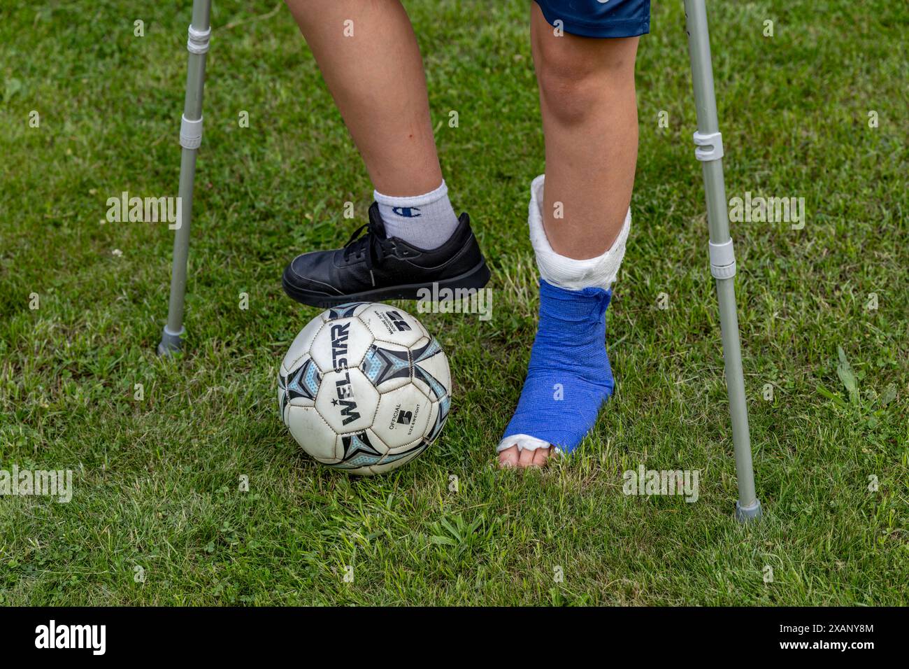 Boy with a broken leg in a cast during a football match an injury to a ...
