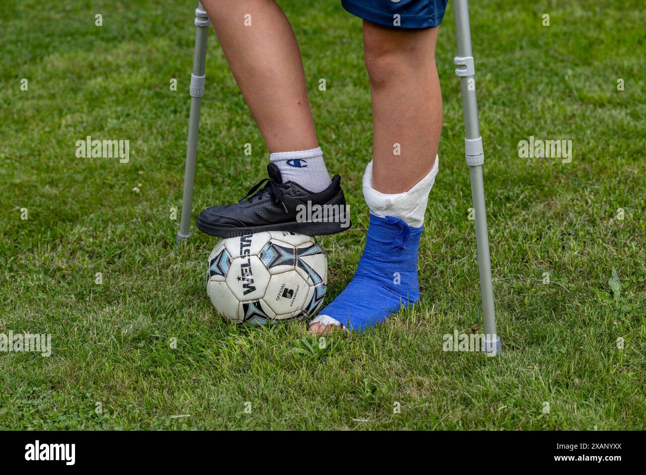 Boy with a broken leg in a cast during a football match an injury to a ...