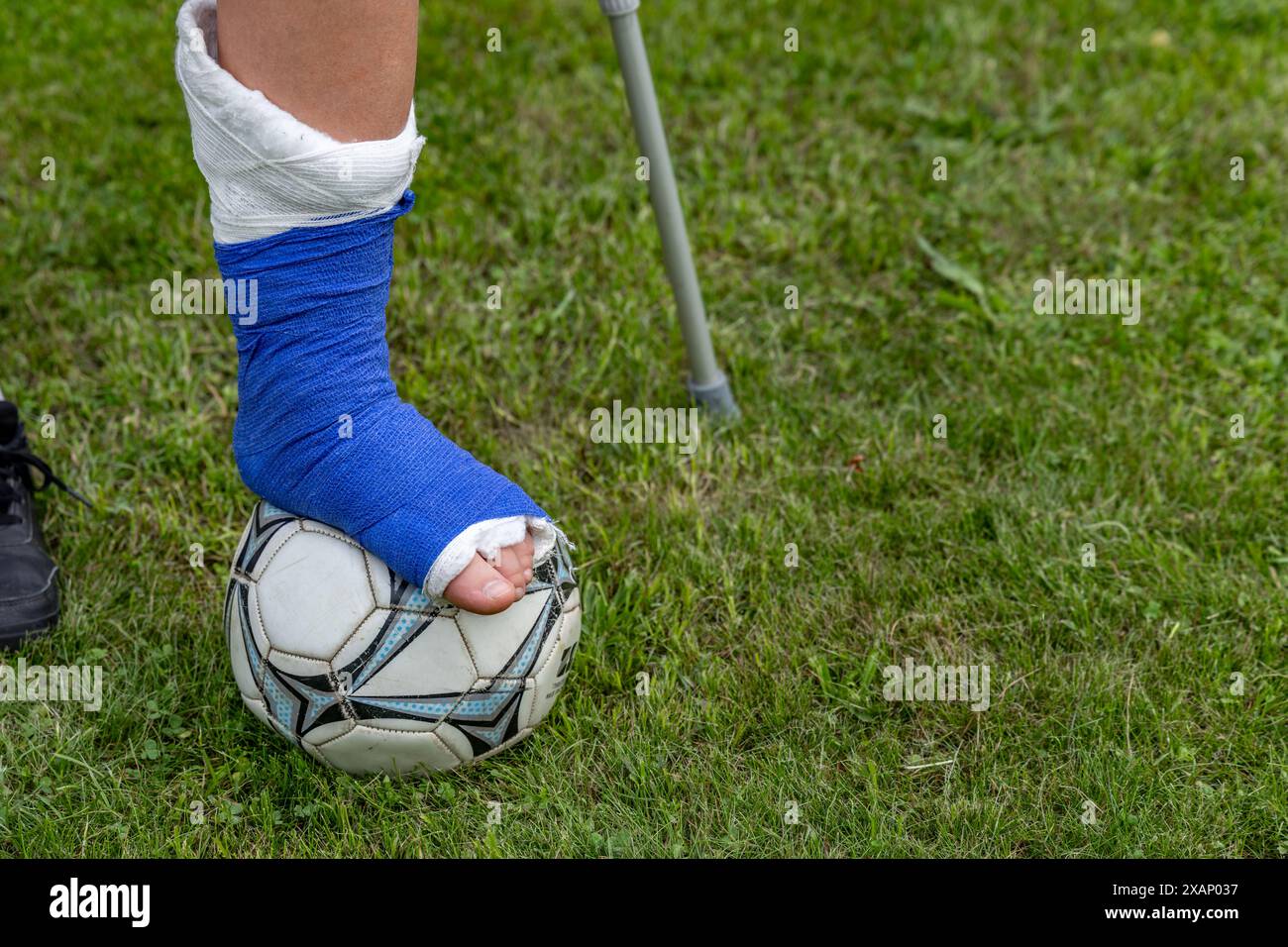 Boy with a broken leg in a cast during a football match an injury to a ...