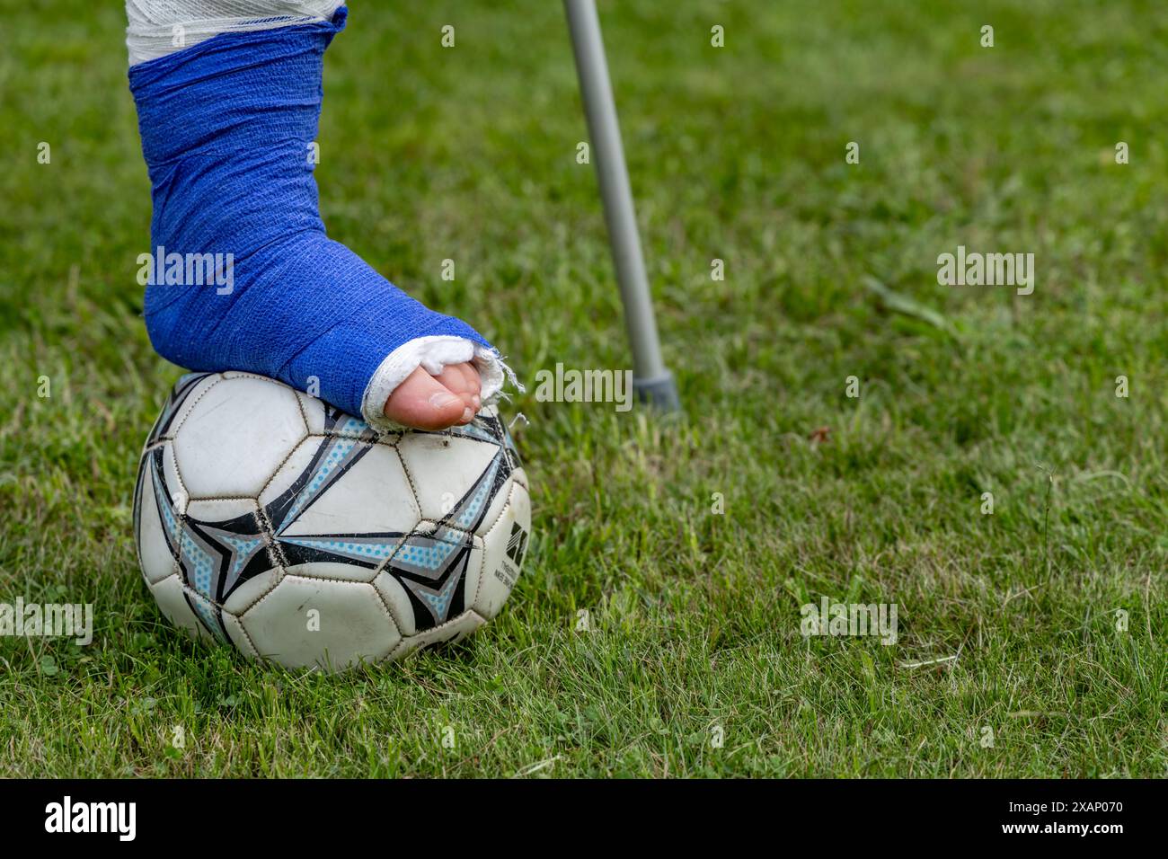 Boy with a broken leg in a cast during a football match an injury to a ...