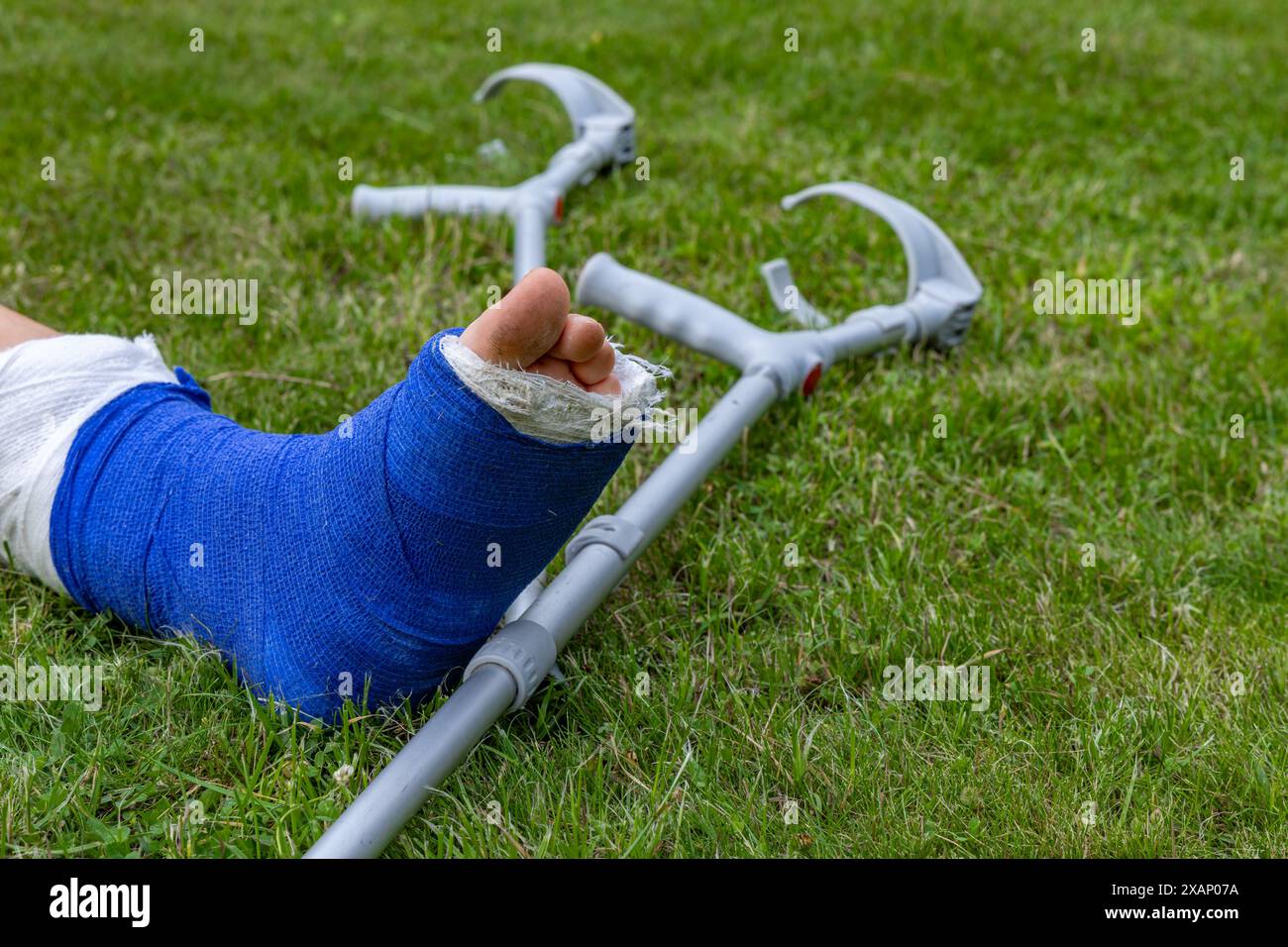 Boy with a broken leg in a cast during a football match an injury to a ...