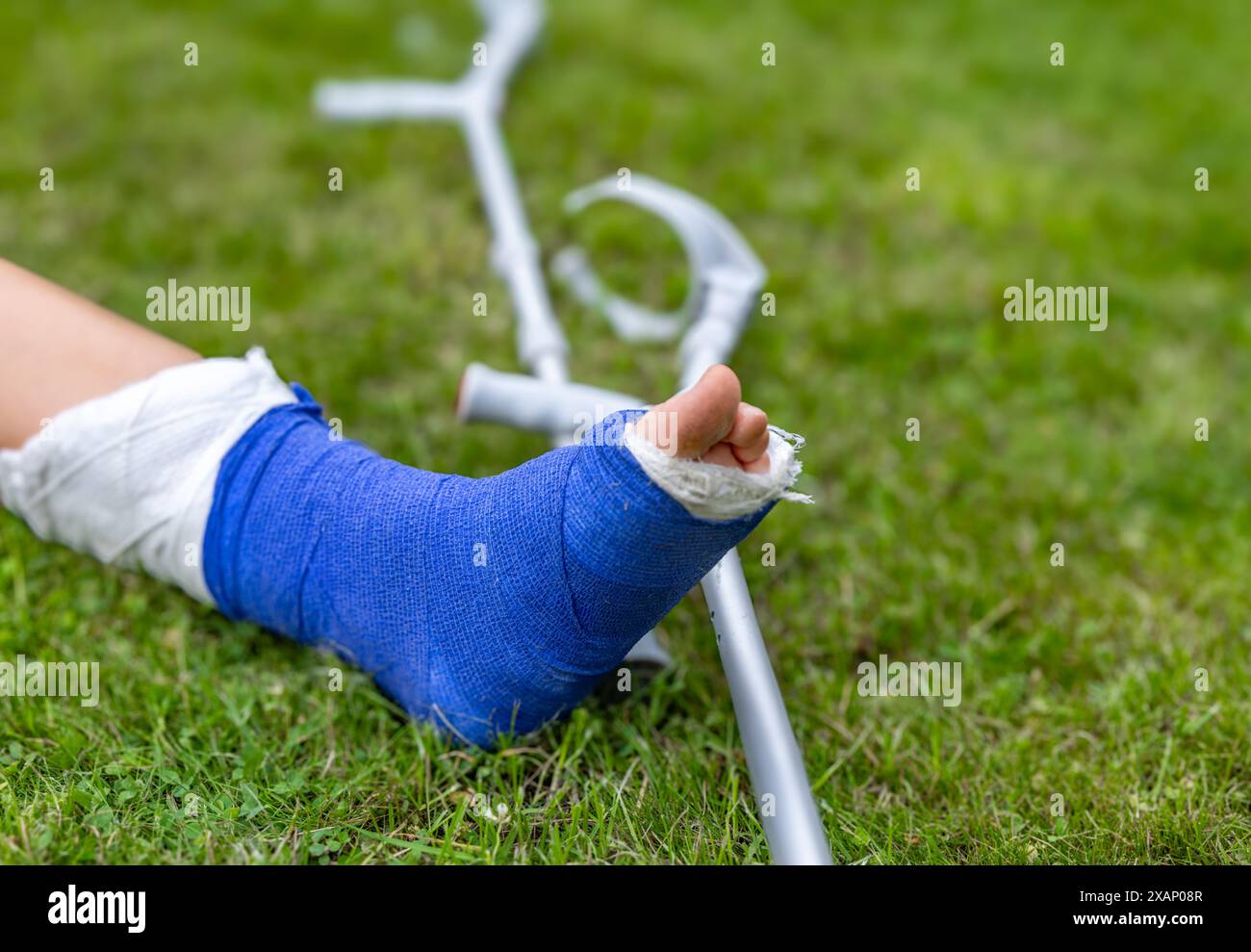 Boy with a broken leg in a cast during a football match an injury to a ...
