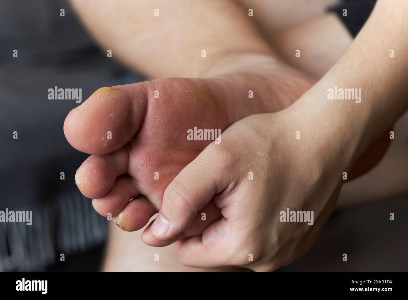 Corns and calluses hi-res stock photography and images - Alamy