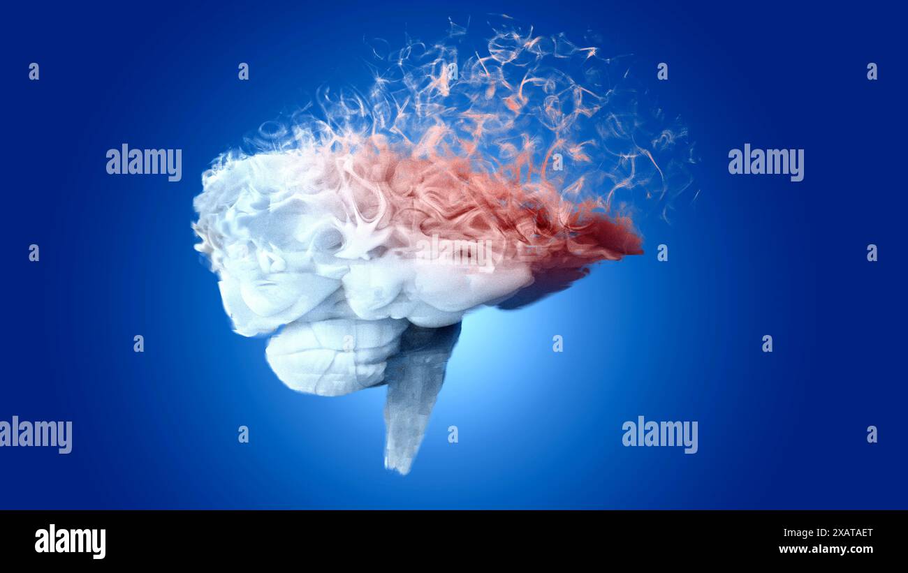 Brain seen from the side. Degenerative disease. Brain degenerative ...