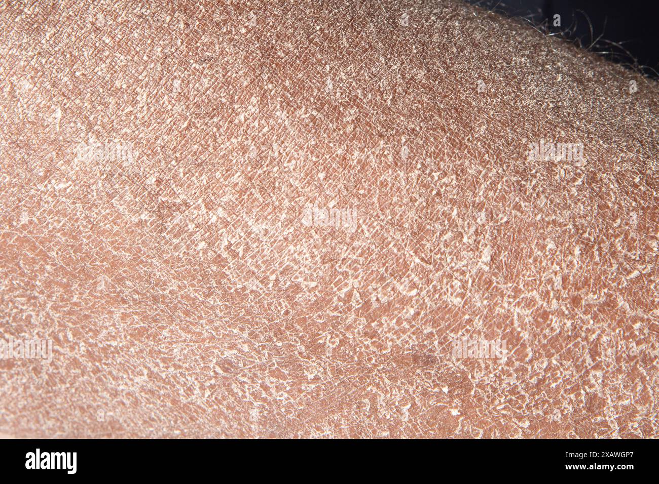 Close-up of a person's skin suffering from severe psoriasis, a common ...