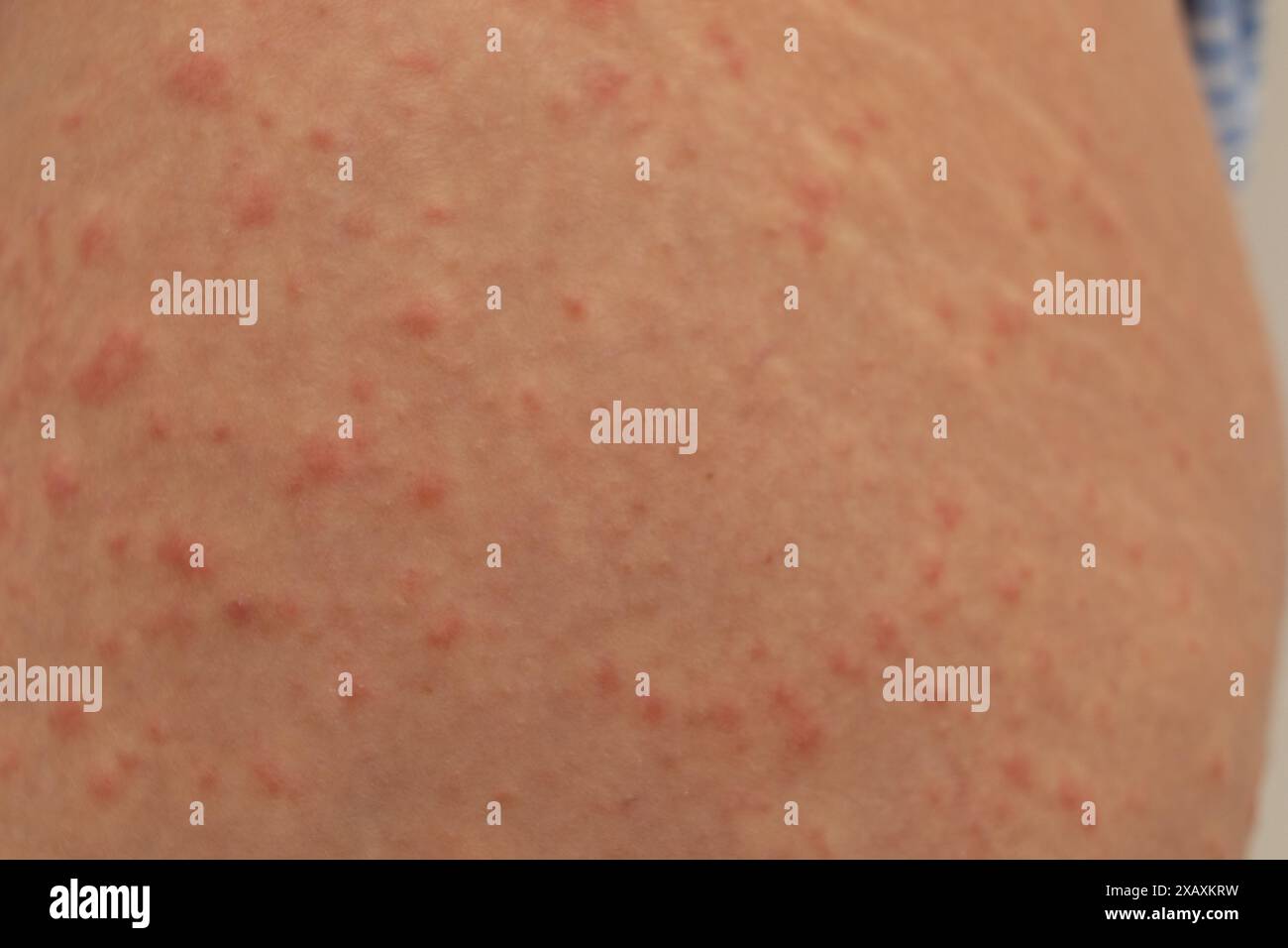 Urticaria allergy on woman legs Stock Photo - Alamy