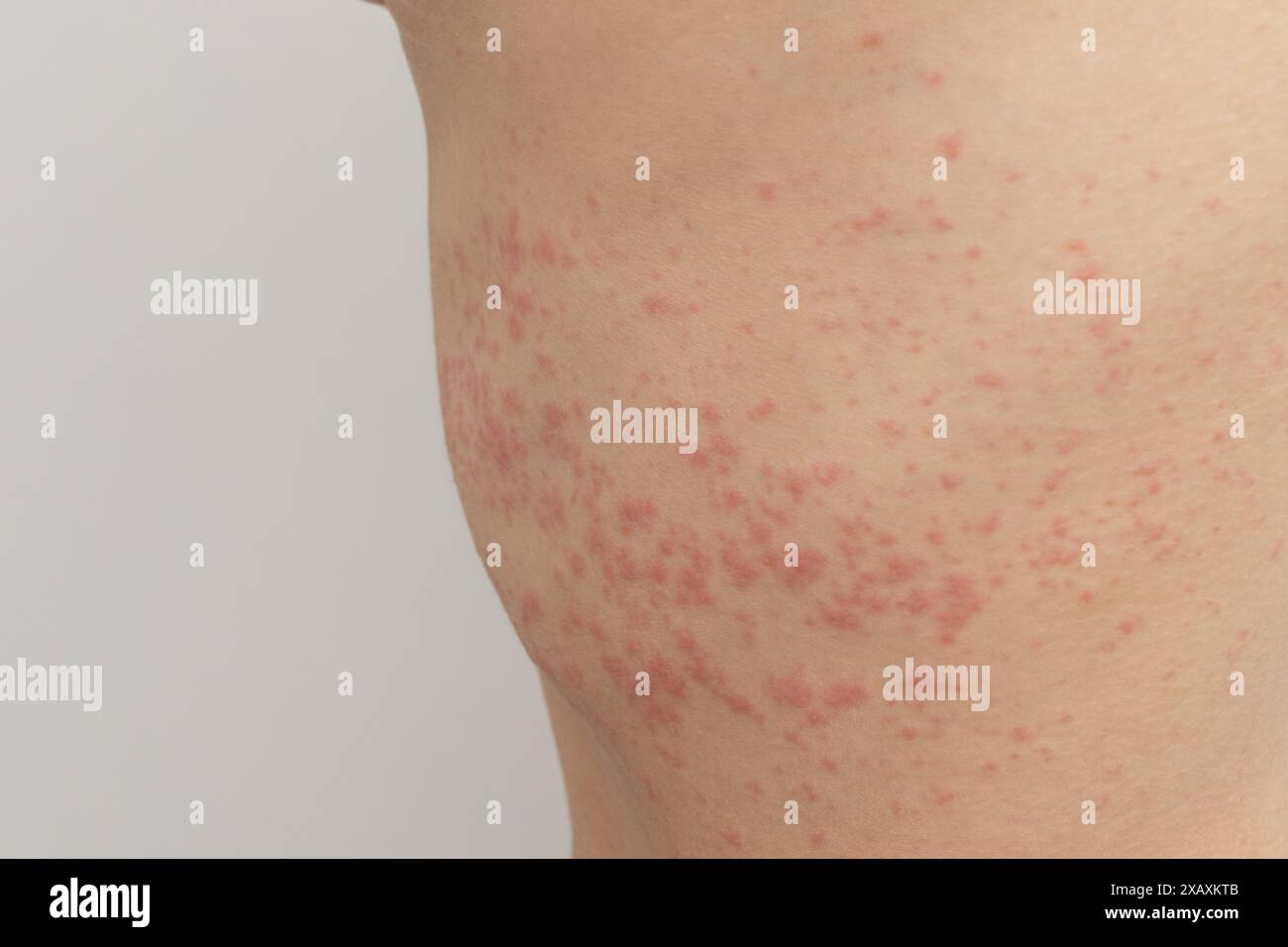 Urticaria is an allergic reaction on the skin. Red spots on the skin ...