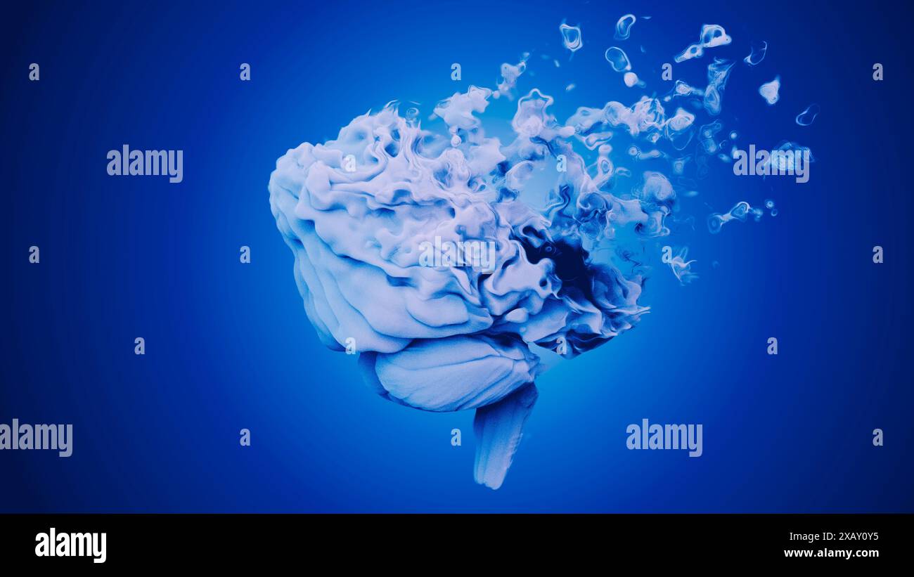 Brain seen from the side. Degenerative disease. Brain degenerative ...