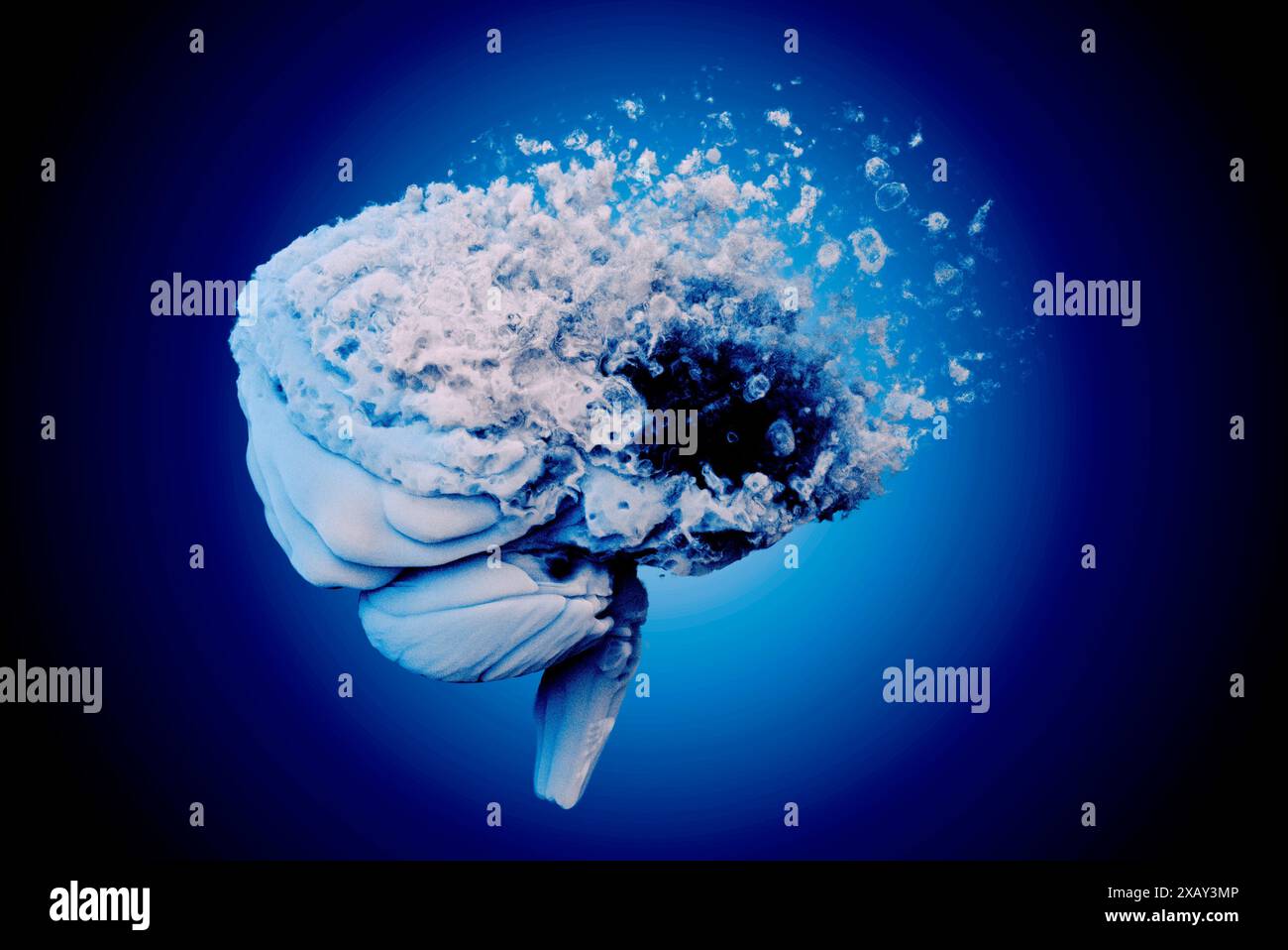 Brain seen from the side. Degenerative disease. Brain degenerative ...