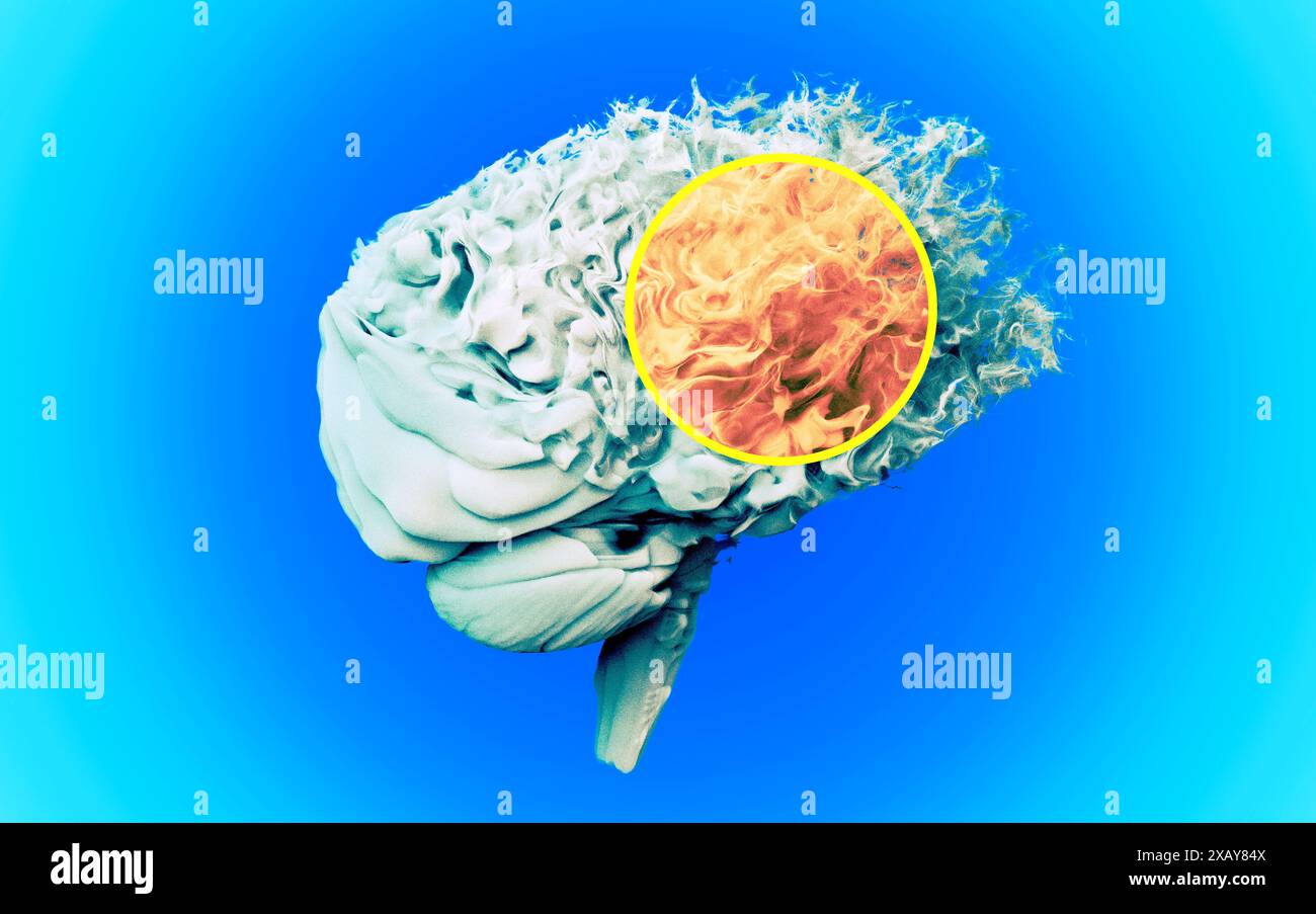 Brain seen from the side. Degenerative disease. Brain degenerative ...