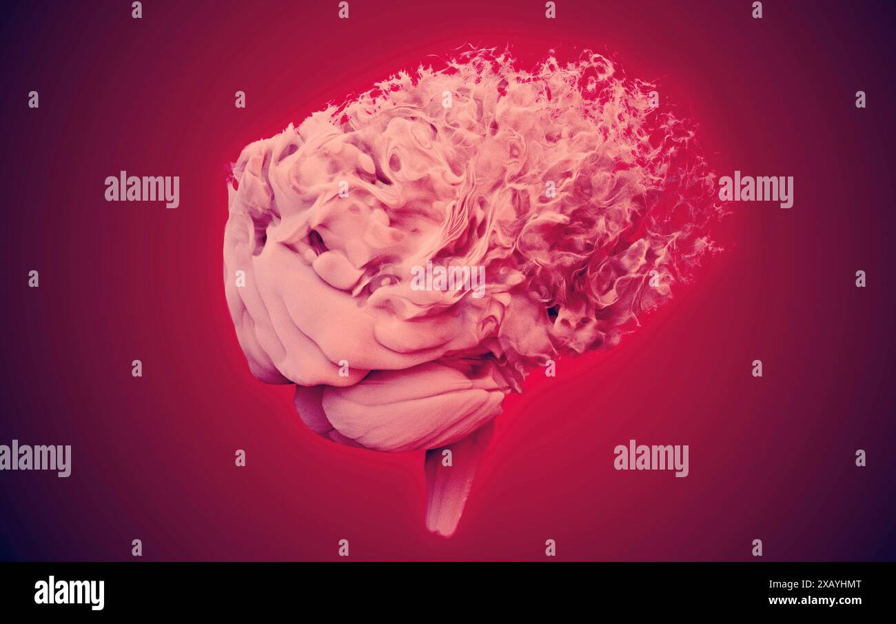 Brain seen from the side. Degenerative disease. Brain degenerative ...