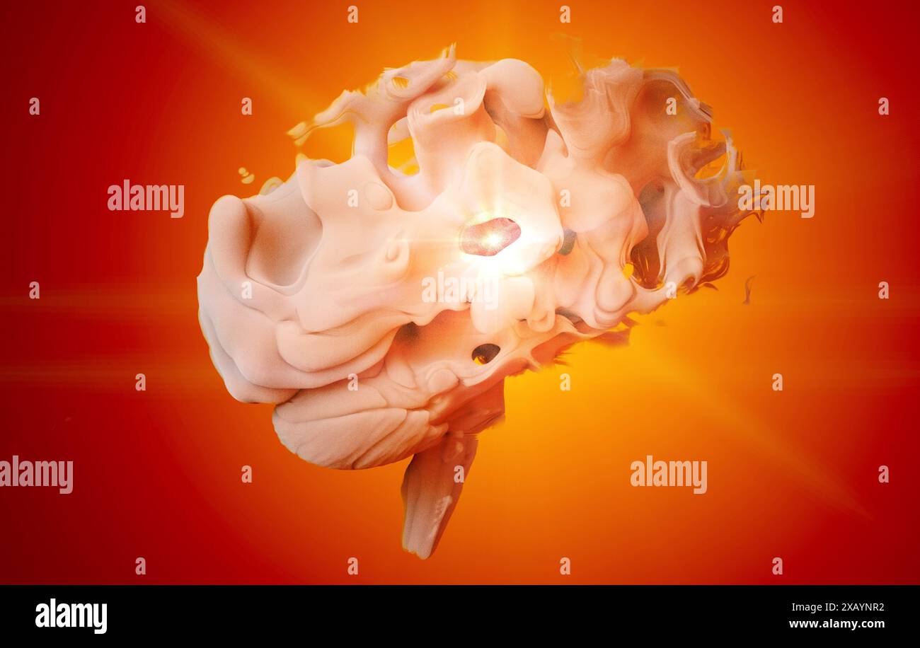 Brain seen from the side. Degenerative disease. Brain degenerative ...