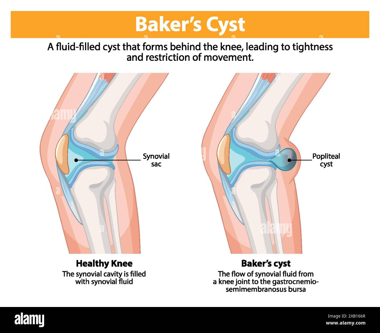 Comparison of healthy knee and Baker's cyst Stock Vector Image & Art - Alamy