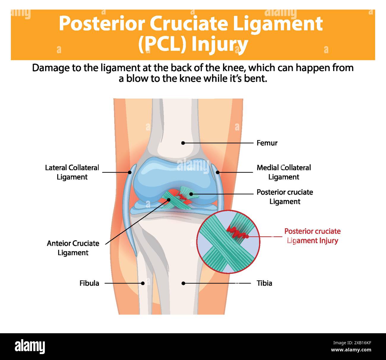 Illustration of PCL injury in the knee joint Stock Vector Image & Art ... Illustration of PCL injury in the knee joint Stock Vector Image & Art ...