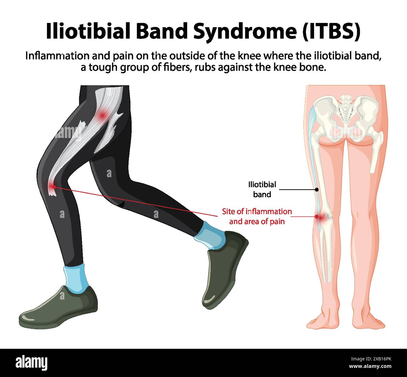 Depiction of ITBS pain and inflammation in knee Stock Vector Image ...