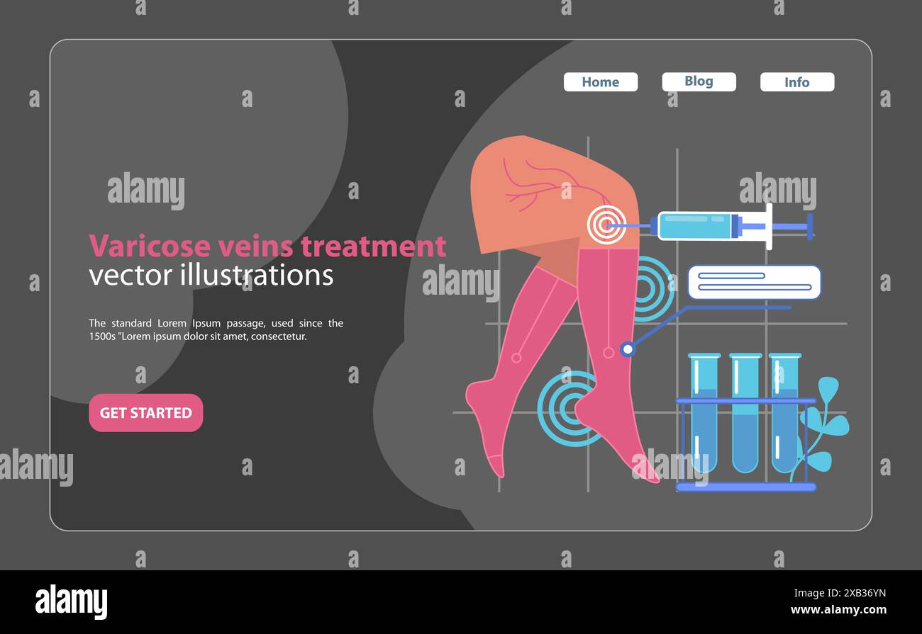 Specialized varicose veins treatment. A medical illustration depicting ...