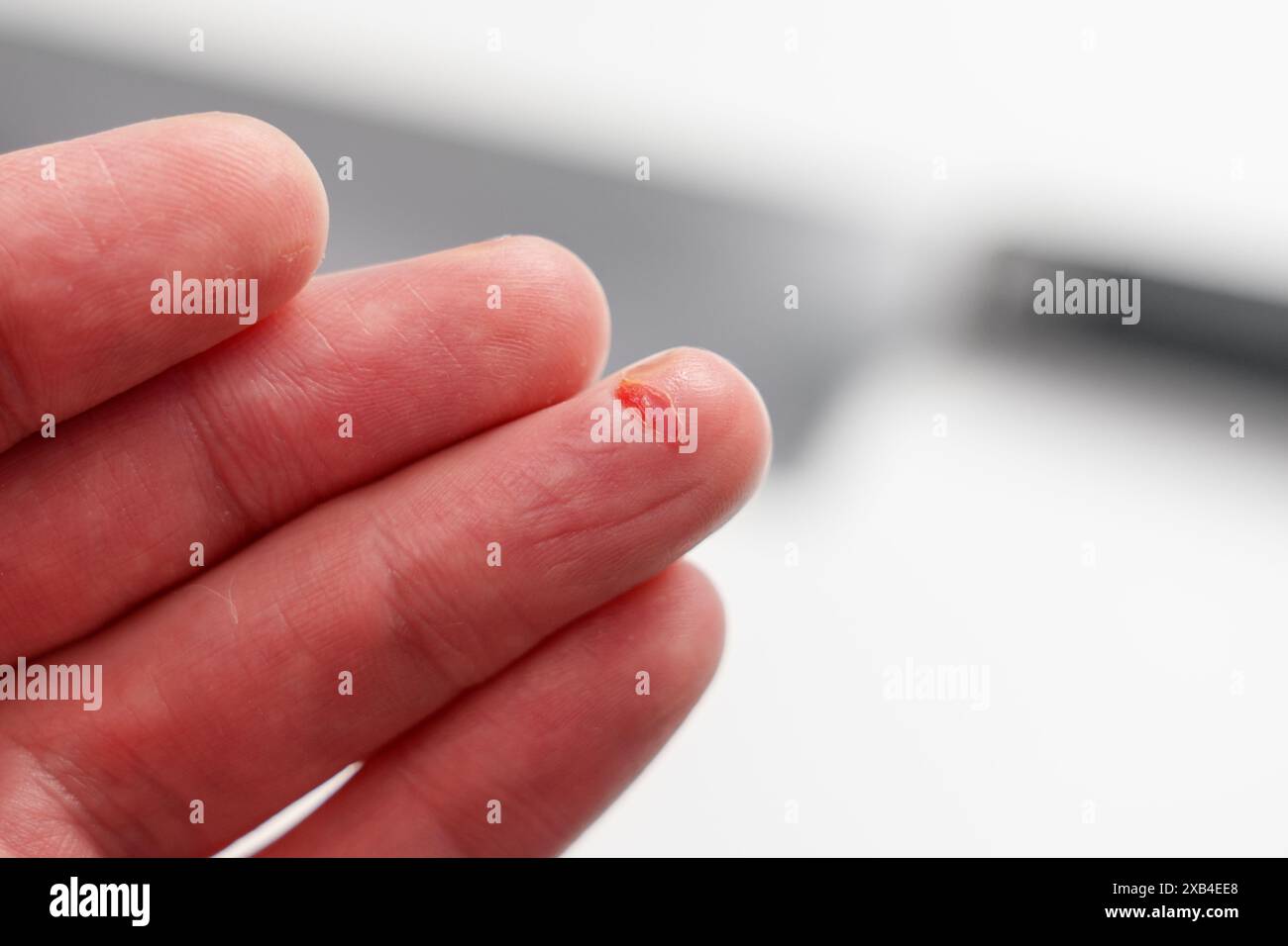 A cut finger from a kitchen accident. Hand injury or wound to the skin ...