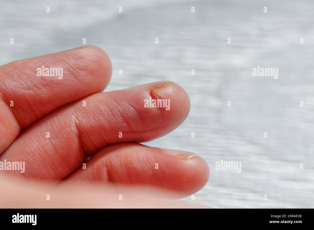 A finger injury or cut received while working in the kitchenю. Caution ...