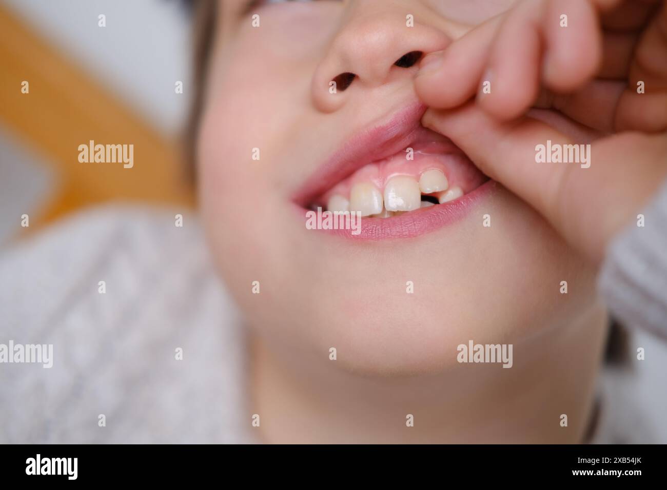 Young Smiling child, boy, age 10 reveals growing teeth, marking ...