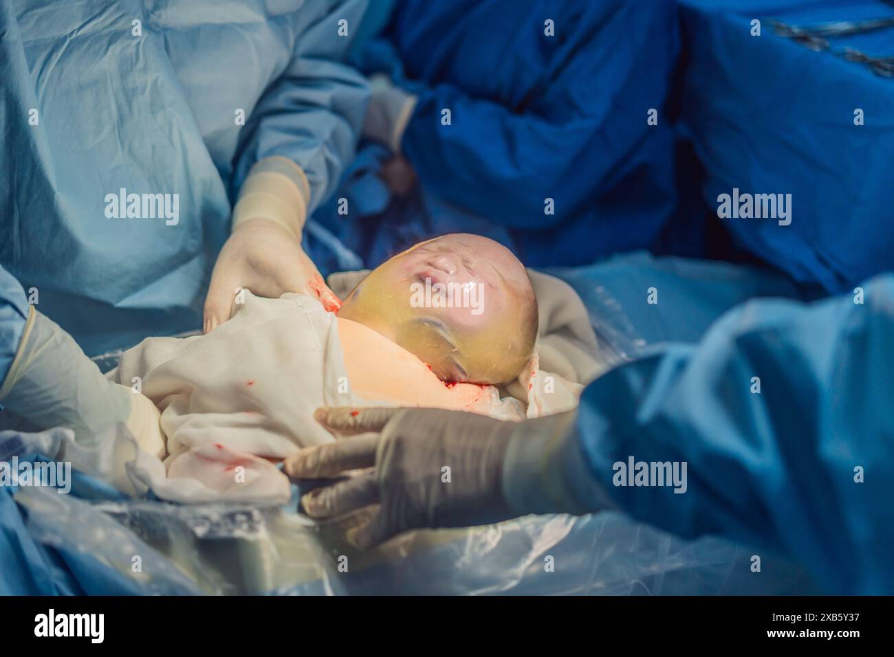 A baby is delivered in an intact amniotic sac during a caesarean ...